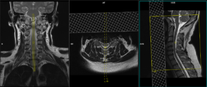 MRI CSF Leak Cervical Spine | MRI CSF Leak Protocol & Planning