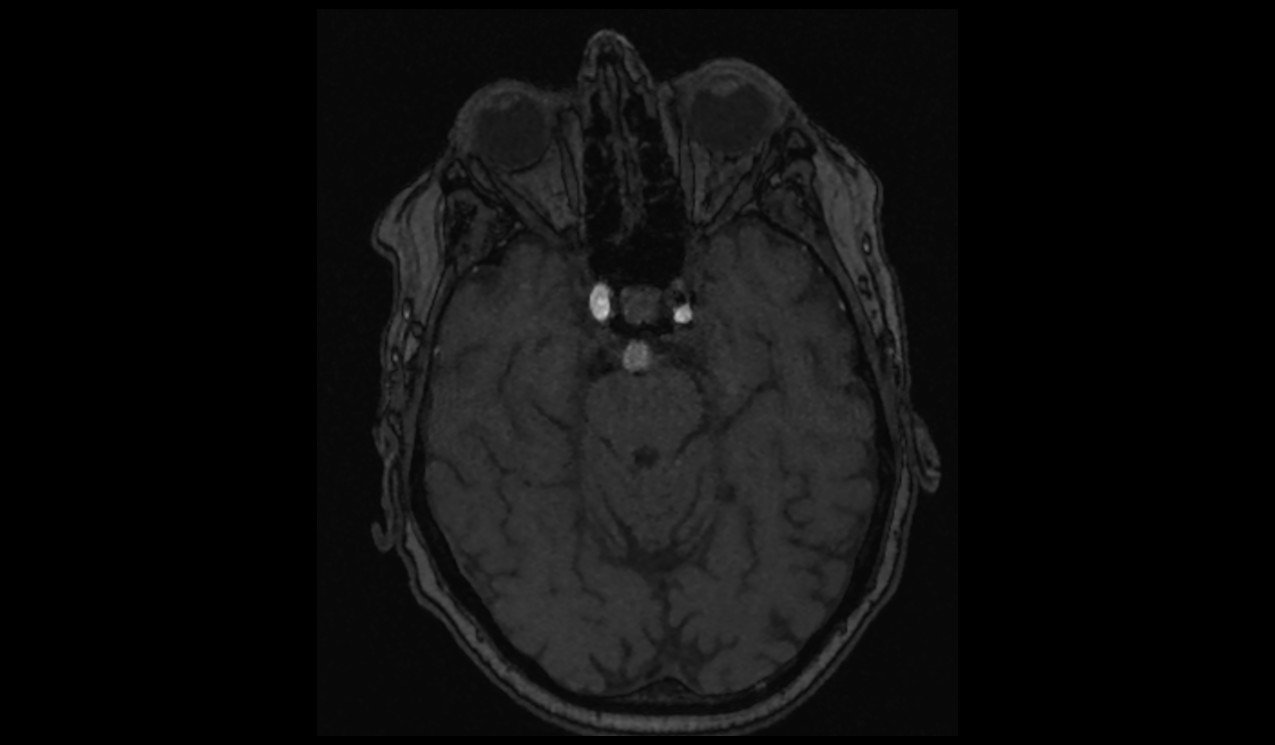 Cerebral aneurysm (berry aneurysms) MRI | Radiology Article on saccular ...