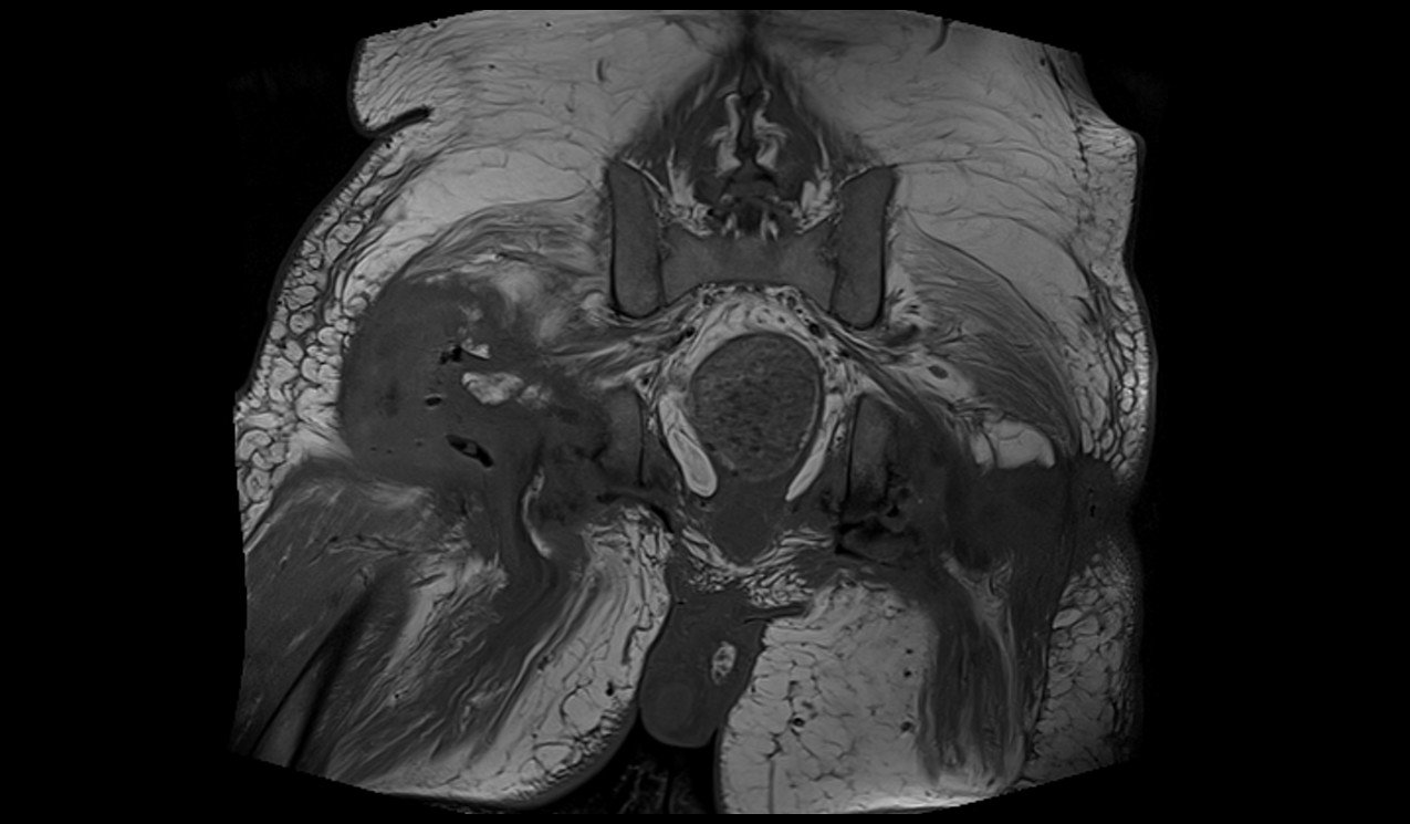 Pelvic ostiomelitis MRI | Radiology article on Pelvic osteomyelitis