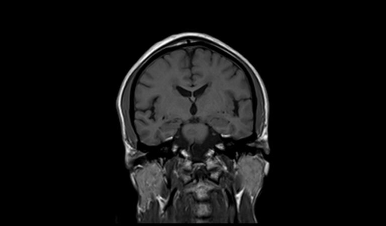 Acute pontine infarct MRI | Radiology Article on pontine stroke
