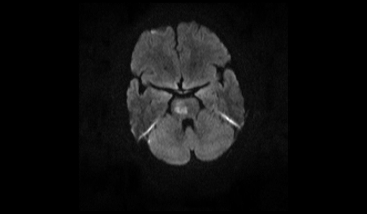 Acute pontine infarct MRI | Radiology Article on pontine stroke