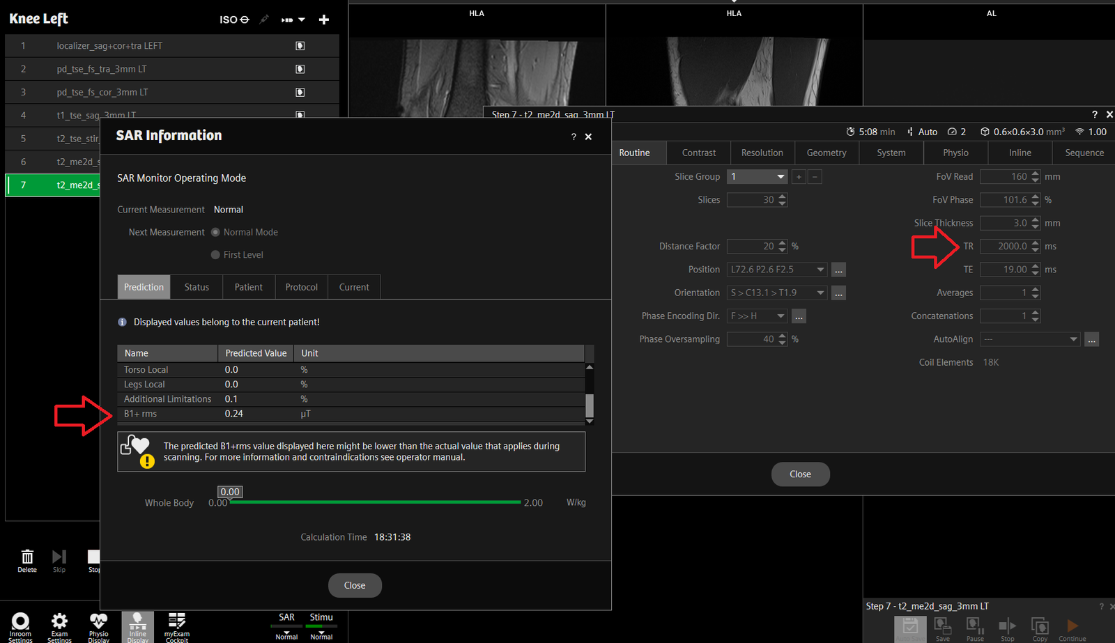 5 gauss line in MRI | Locating the Gauss Line