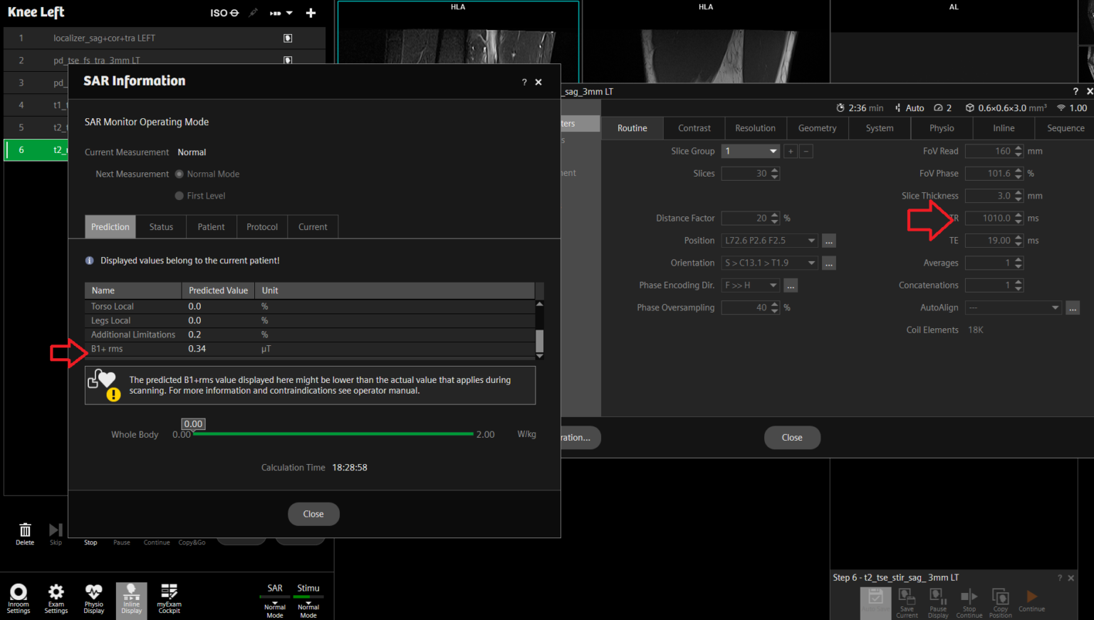 5 gauss line in MRI | Locating the Gauss Line