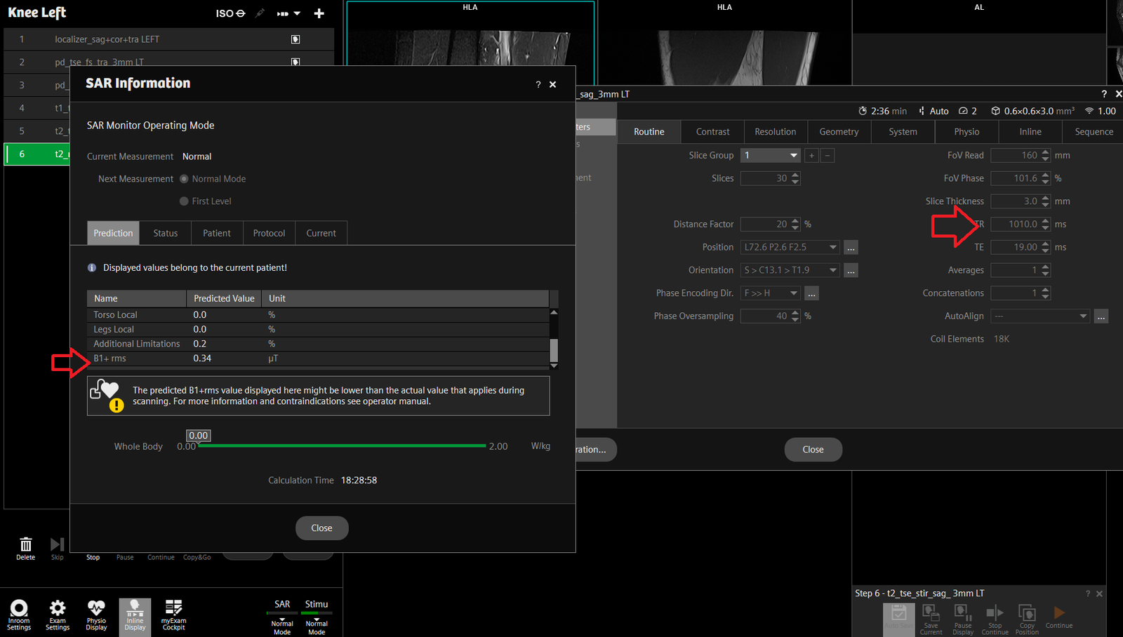 5 gauss line in MRI | Locating the Gauss Line