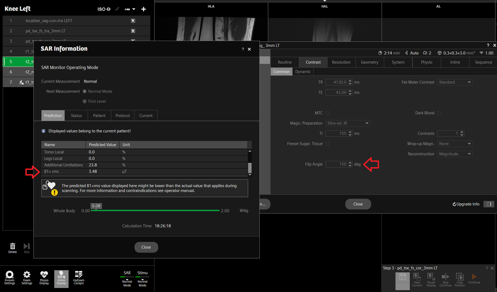 5 gauss line in MRI | Locating the Gauss Line