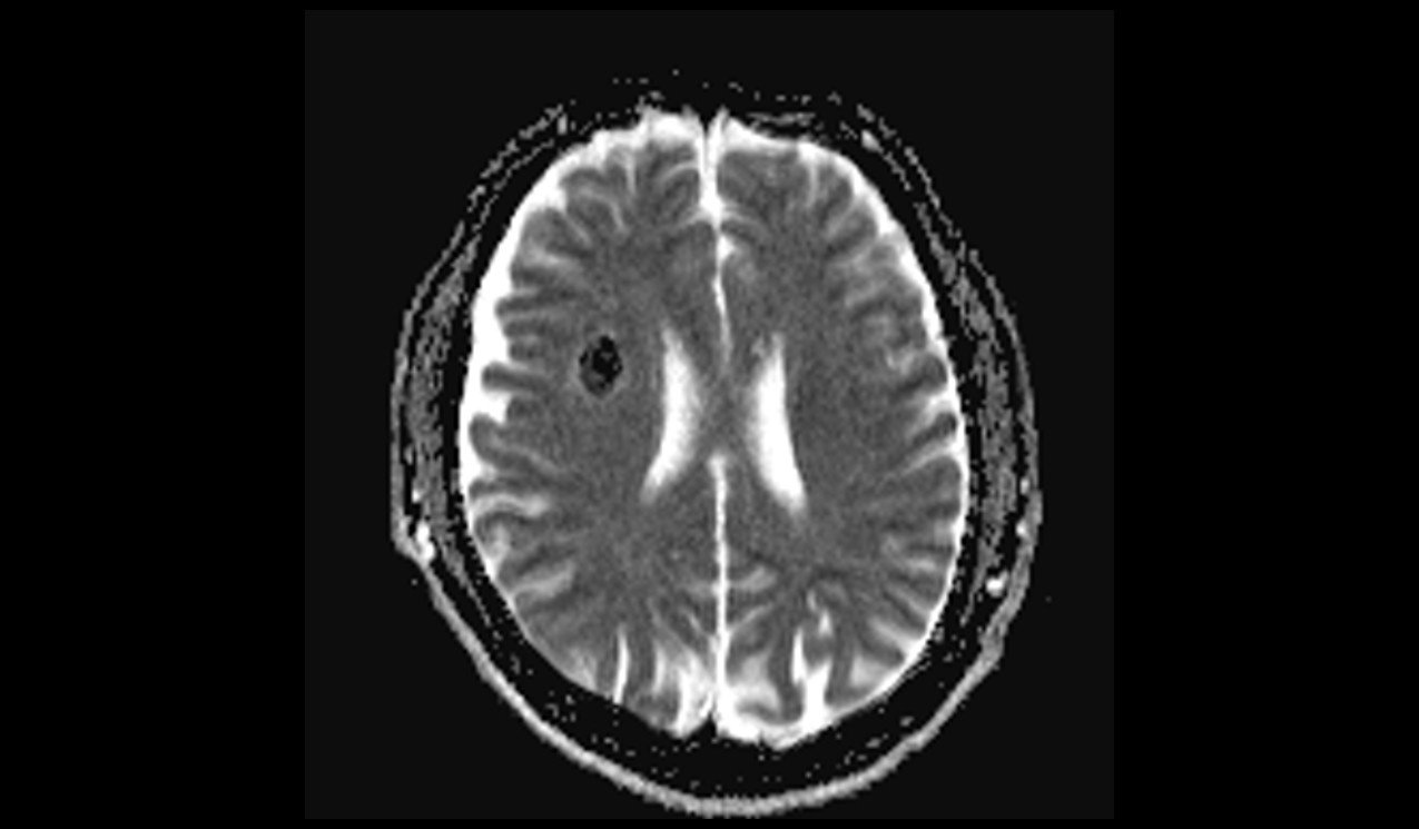 Cavernoma MRI | Radiology Article on Cavernous Hemangioma