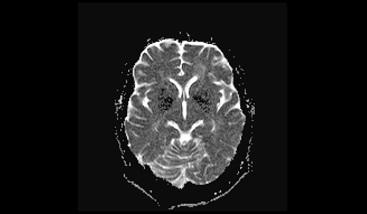 Fahr Syndrome MRI | Radiology Article on Bilateral ...