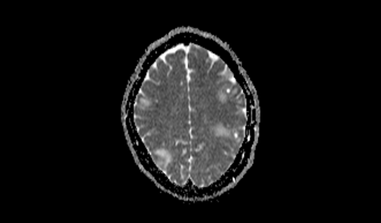 Neurocysticercosis MRI | Radiology Article on Neurocysticercosis