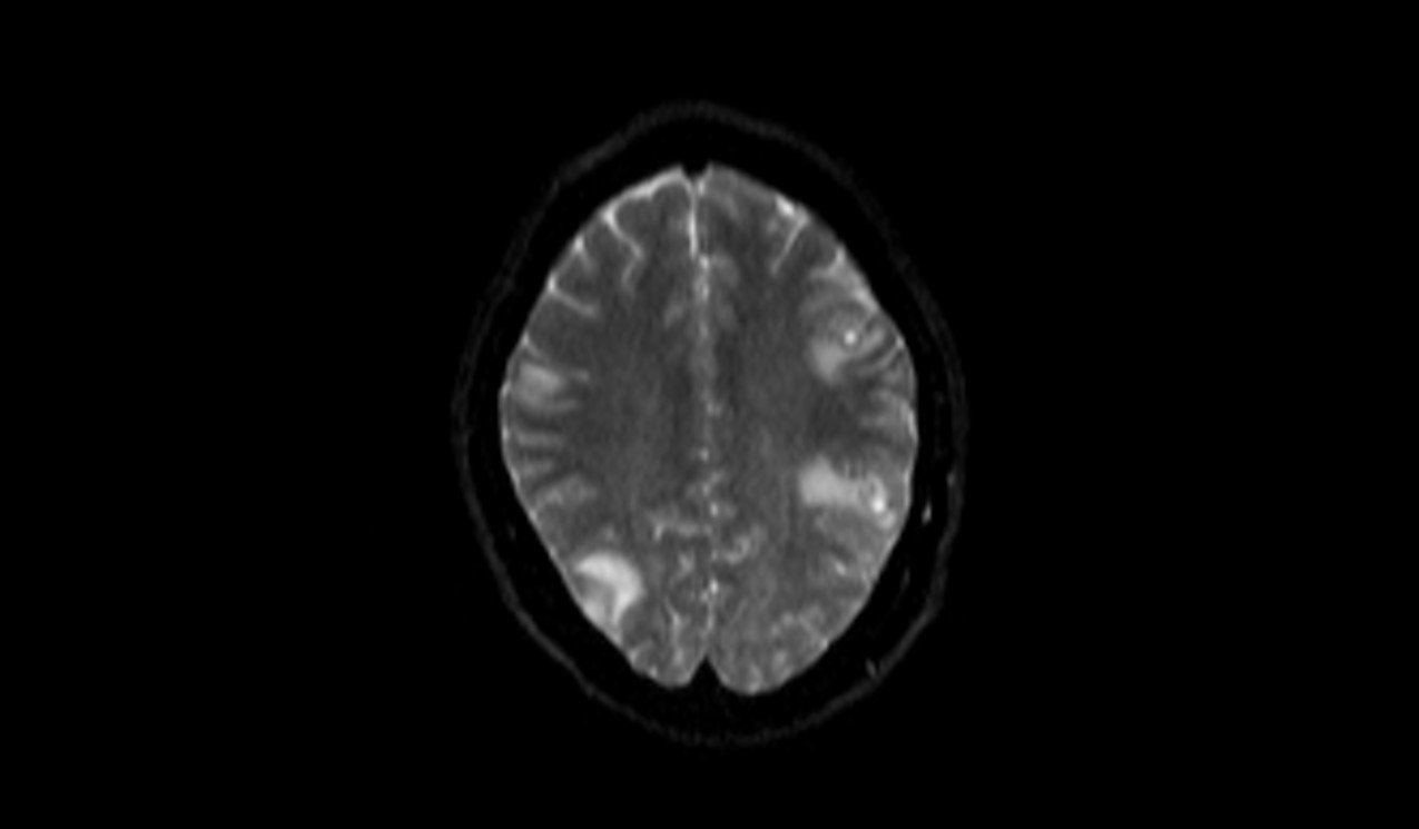 Neurocysticercosis MRI | Radiology Article on Neurocysticercosis