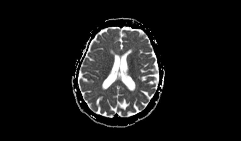 Multiple sclerosis(MS) MRI | Radiology Article on Multiple sclerosis