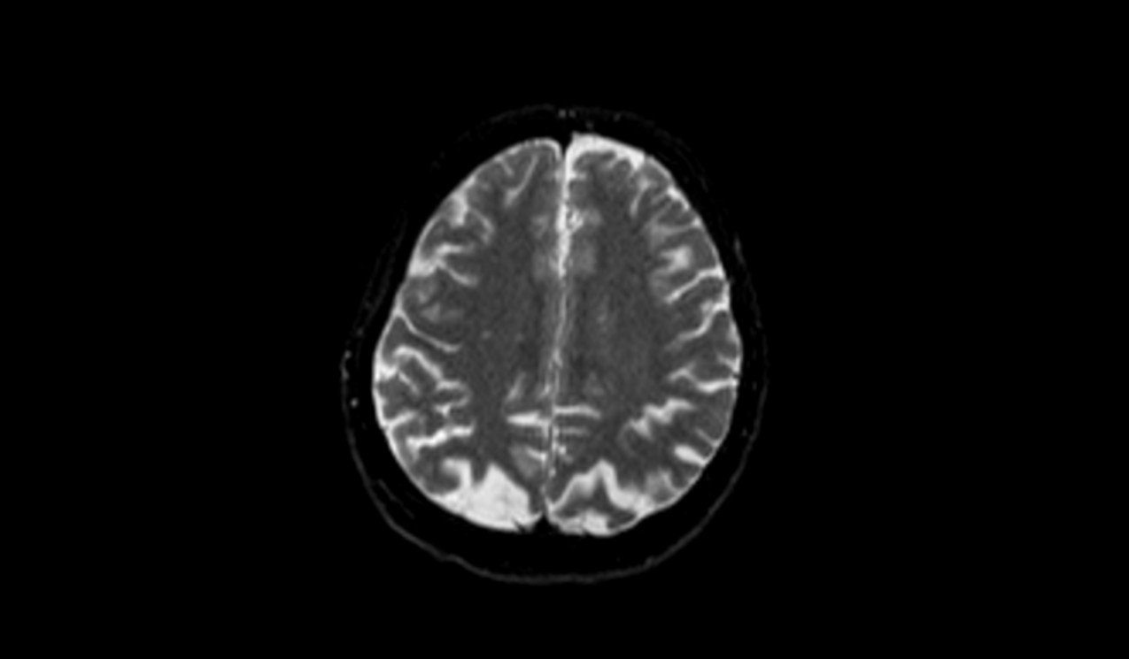 Tuberculoma MRI | Radiology Article on Brain Tuberculoma
