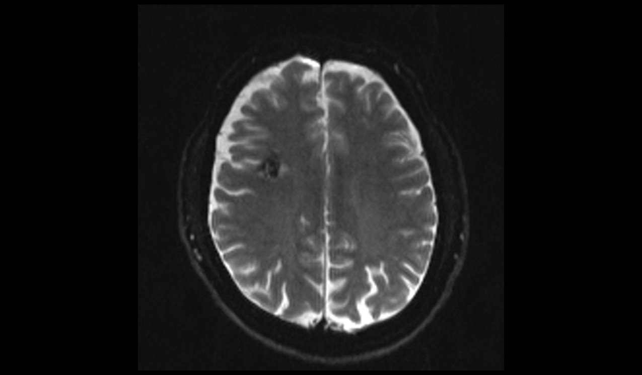 Cavernoma MRI | Radiology Article on Cavernous Hemangioma
