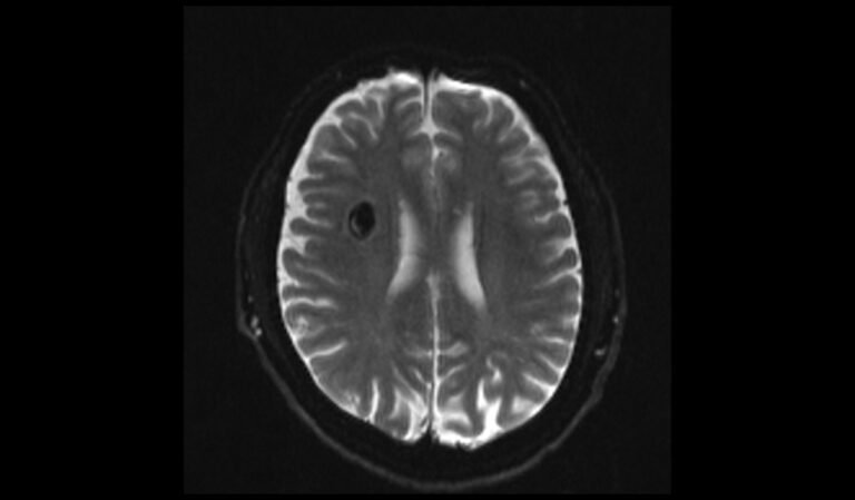 Cavernoma MRI | Radiology Article on Cavernous Hemangioma