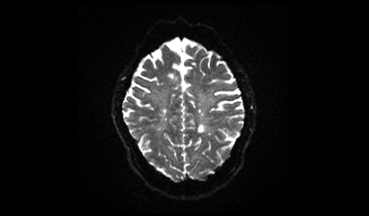 Multiple sclerosis(MS) MRI | Radiology Article on Multiple sclerosis