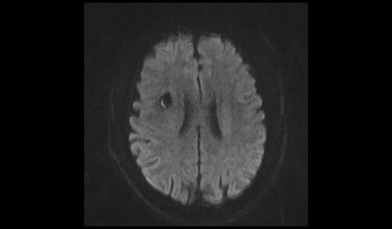 Cavernoma MRI | Radiology Article on Cavernous Hemangioma