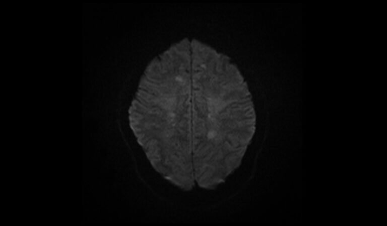Multiple sclerosis(MS) MRI | Radiology Article on Multiple sclerosis