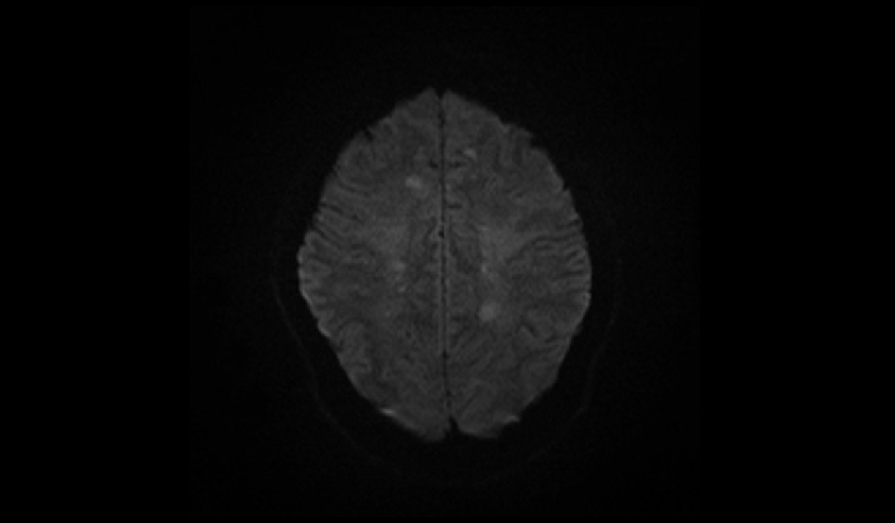 Multiple sclerosis(MS) MRI | Radiology Article on Multiple sclerosis