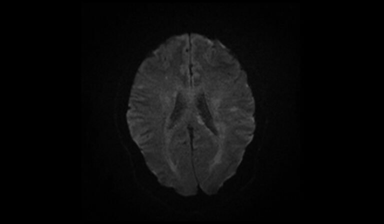 Multiple sclerosis(MS) MRI | Radiology Article on Multiple sclerosis