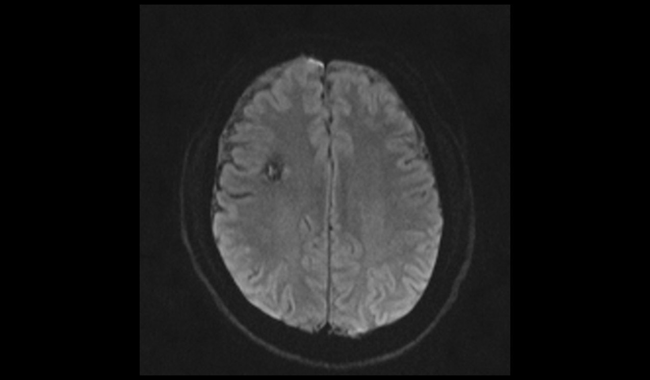 Cavernoma MRI | Radiology Article on Cavernous Hemangioma