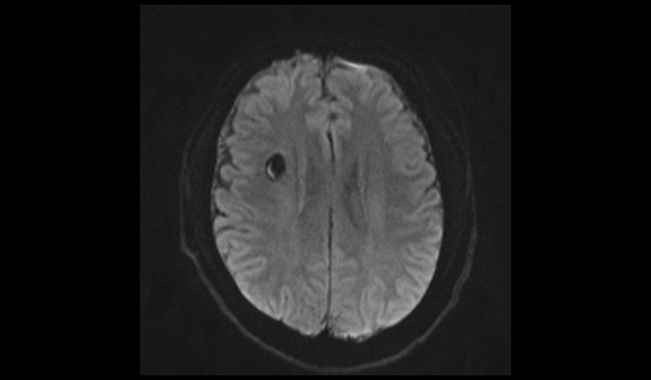 Cavernoma MRI | Radiology Article on Cavernous Hemangioma