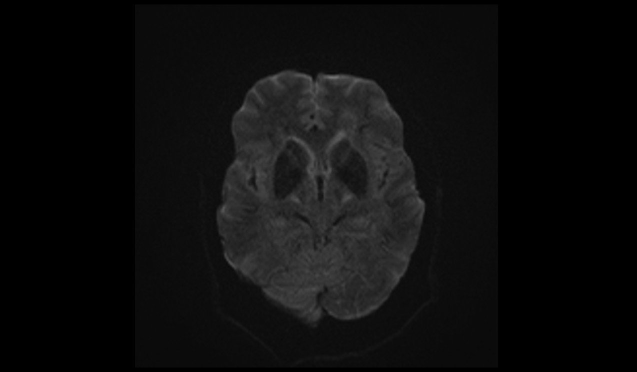 Fahr Syndrome MRI | Radiology Article on Bilateral ...