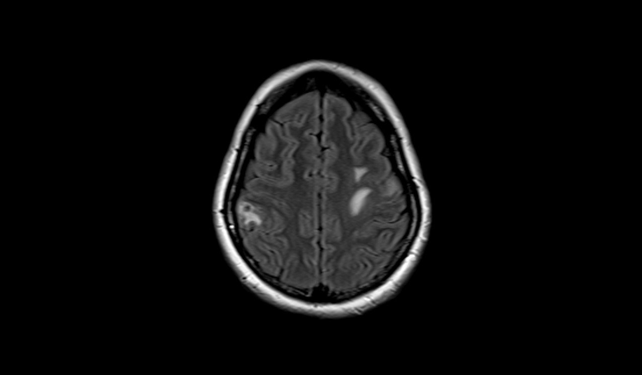 Neurocysticercosis MRI | Radiology Article on Neurocysticercosis