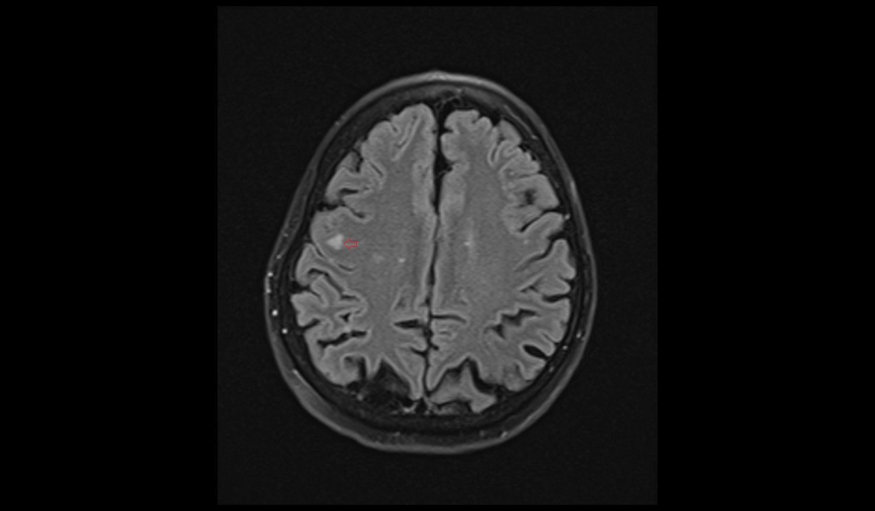 Tuberculoma MRI | Radiology Article on Brain Tuberculoma