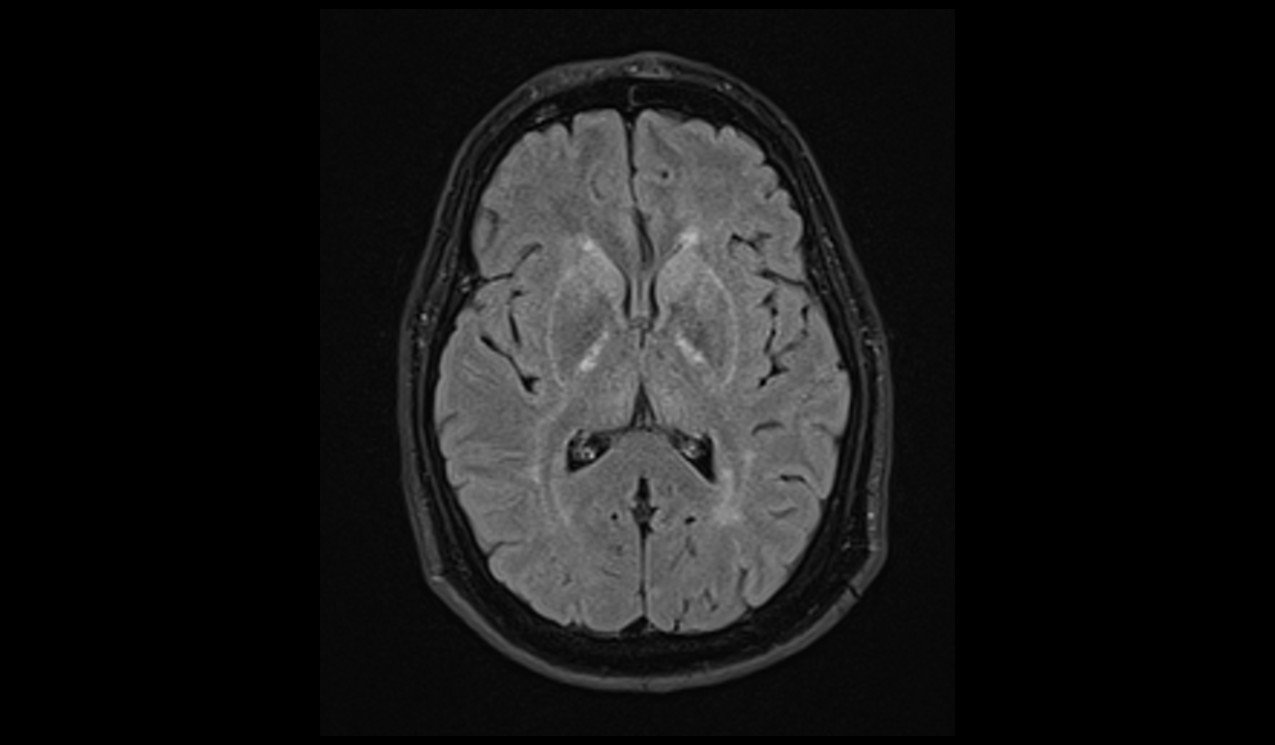 Fahr Syndrome Radiology: Fahr’S Syndrome Pdf – DYMFBR