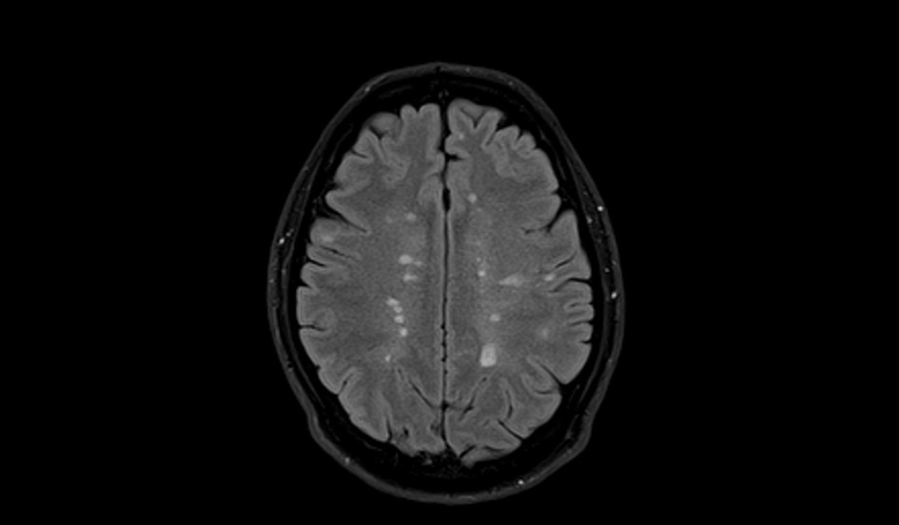 Multiple sclerosis(MS) MRI | Radiology Article on Multiple sclerosis