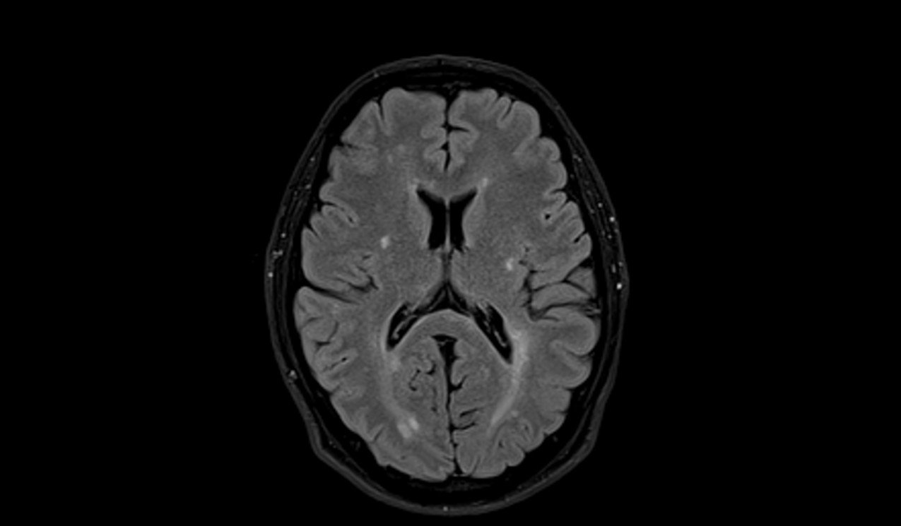 Multiple sclerosis(MS) MRI | Radiology Article on Multiple sclerosis