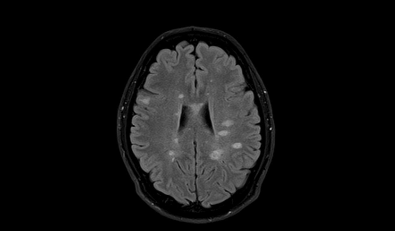 Multiple sclerosis(MS) MRI | Radiology Article on Multiple sclerosis
