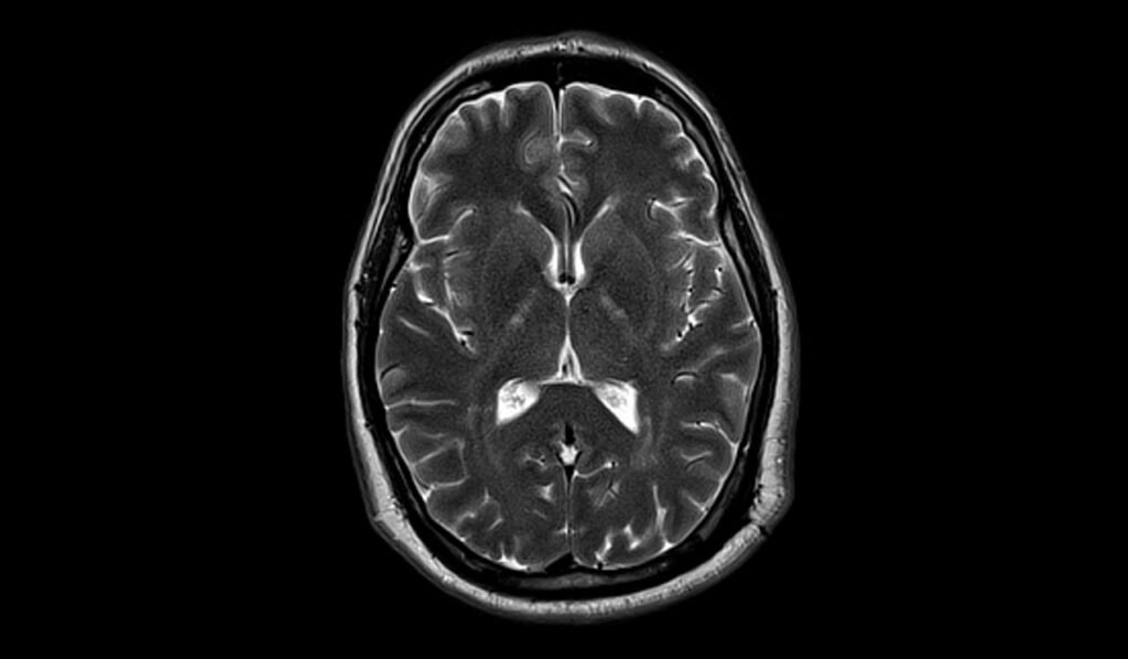 Fahr Syndrome MRI | Radiology Article on Bilateral ...