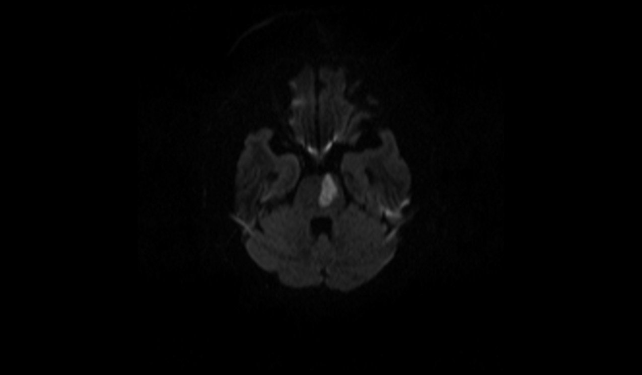 Acute Pontine Infarct MRI | Radiology Article on Acute Pontine stroke MRI