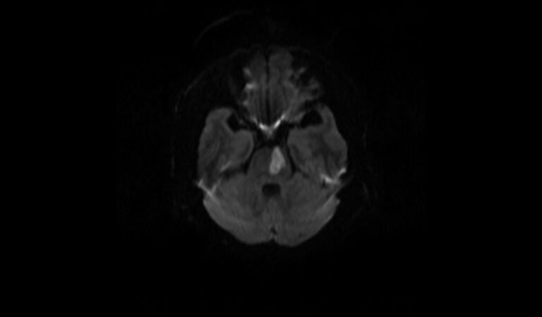 Acute Pontine Infarct MRI | Radiology Article on Acute Pontine stroke MRI