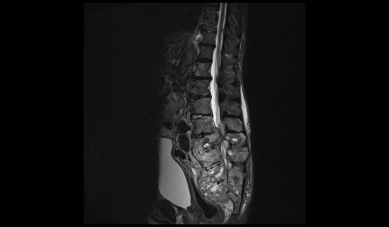Sacral metastases (Tumours) MRI | Radiology article on Sacral metastases