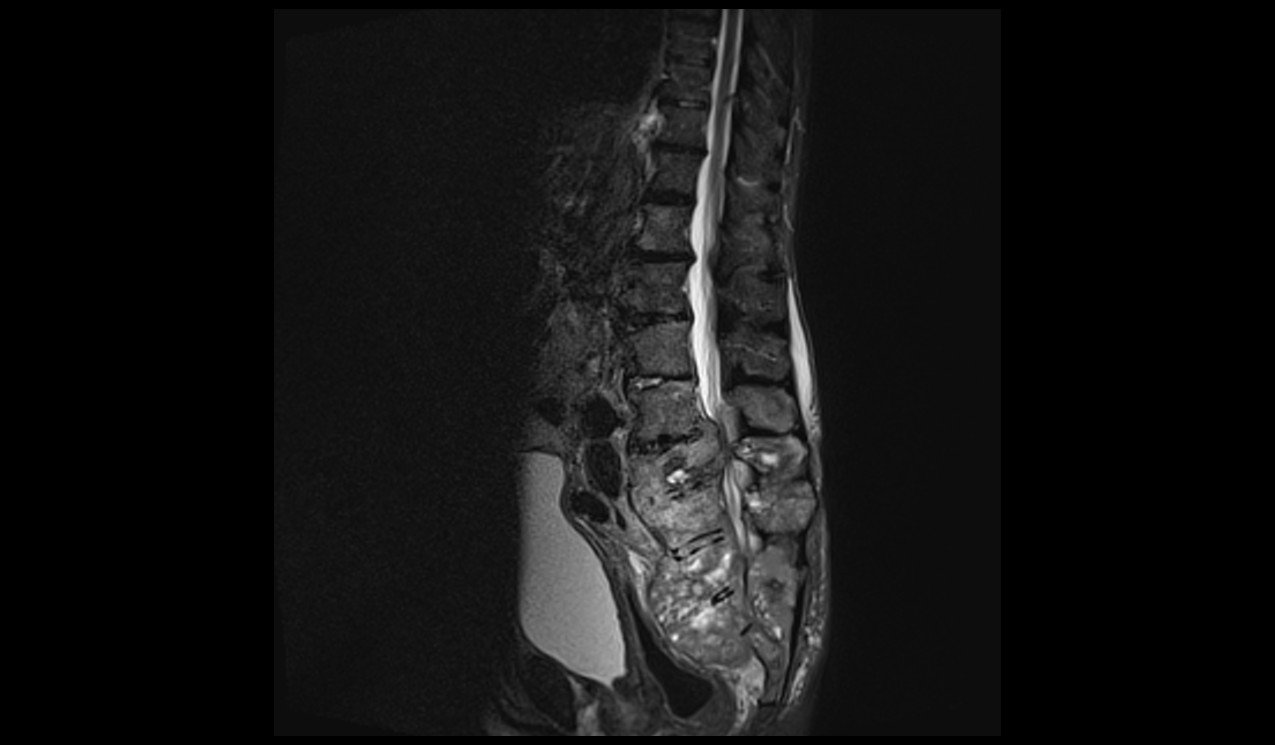Sacral metastases (Tumours) MRI | Radiology article on Sacral metastases