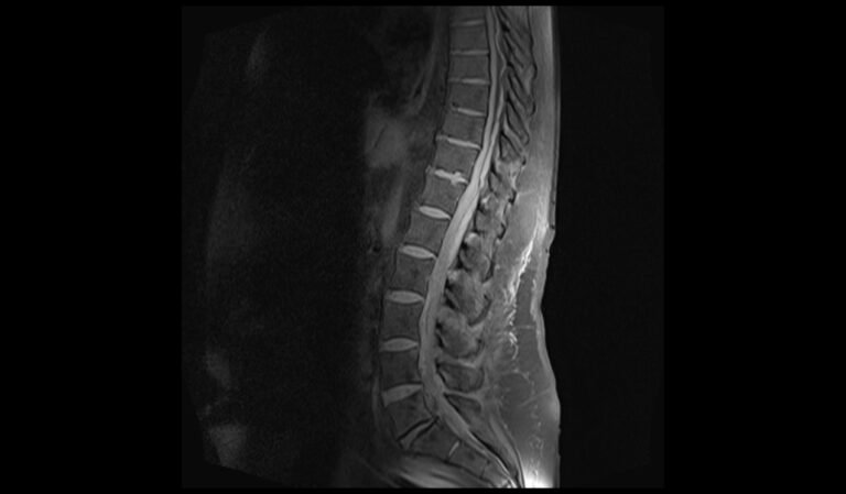 Spinal epidural hematoma MRI | Radiology article on Spinal epidural ...