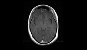 Neurocysticercosis MRI | Radiology Article on Neurocysticercosis