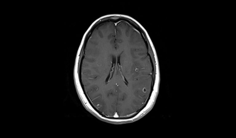 Neurocysticercosis MRI | Radiology Article on Neurocysticercosis