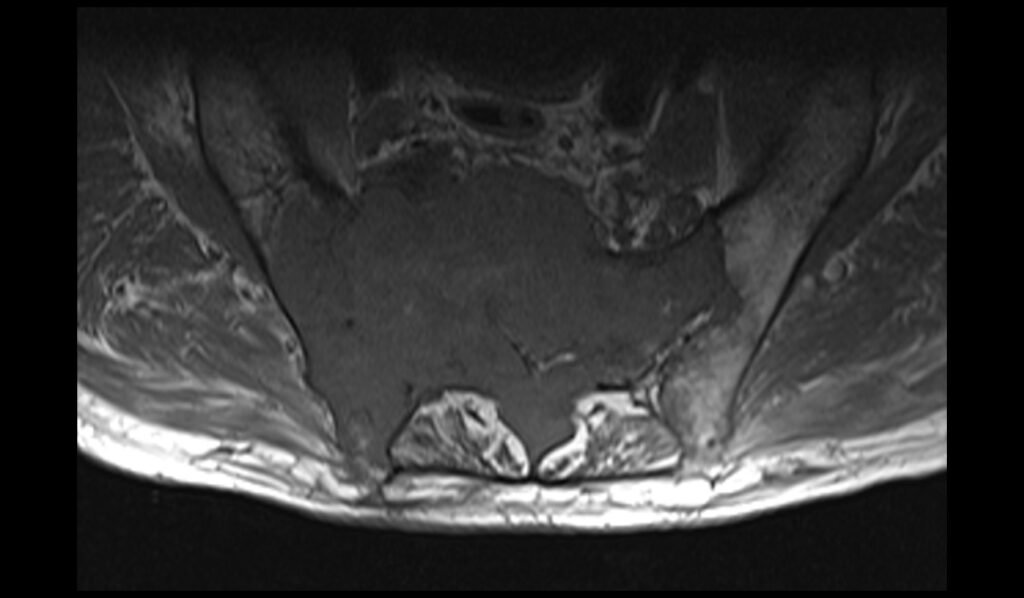 Sacral metastases (Tumours) MRI | Radiology article on Sacral metastases