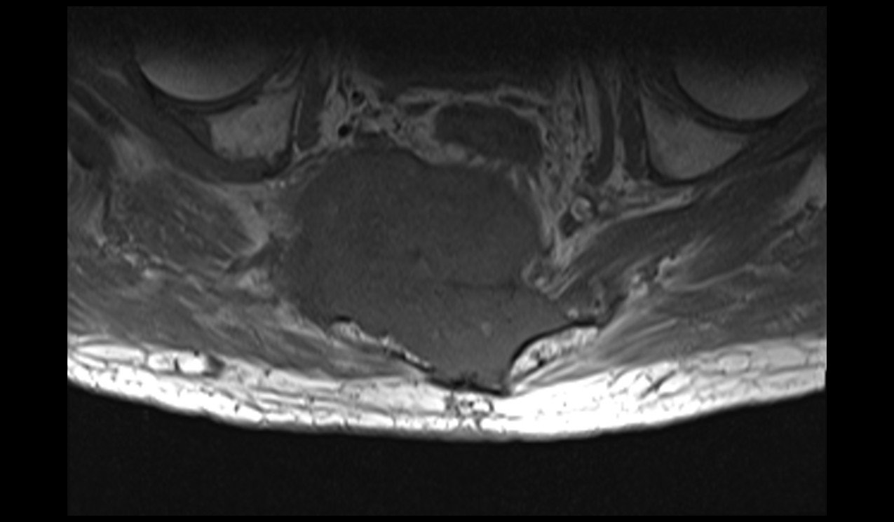 Sacral metastases (Tumours) MRI | Radiology article on Sacral metastases