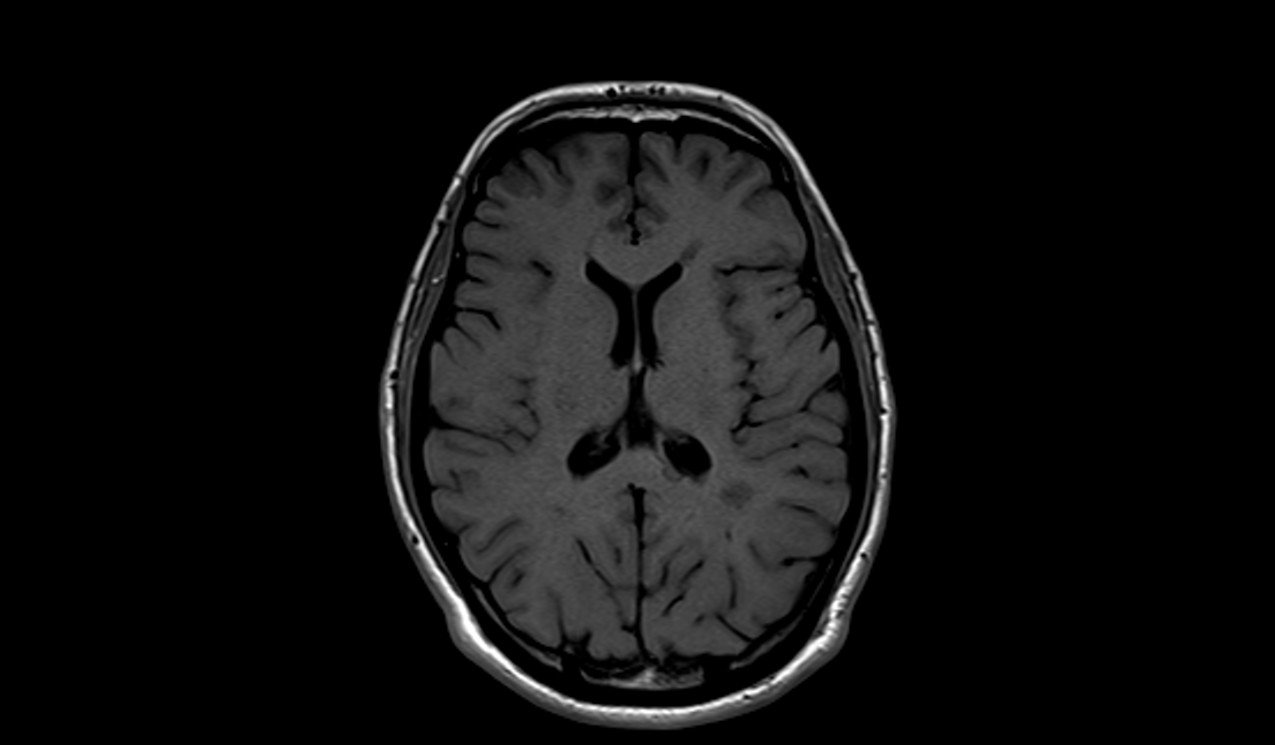 Multiple sclerosis(MS) MRI | Radiology Article on Multiple sclerosis