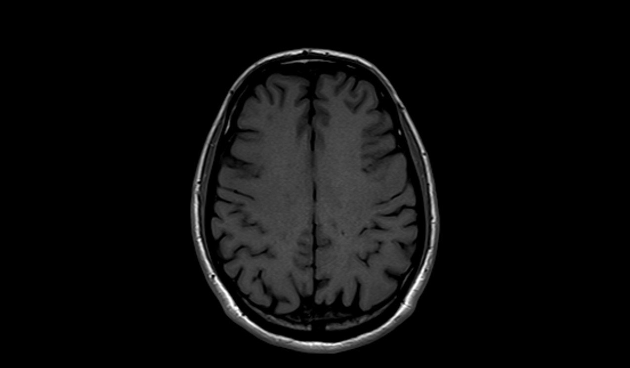 Multiple sclerosis(MS) MRI | Radiology Article on Multiple sclerosis