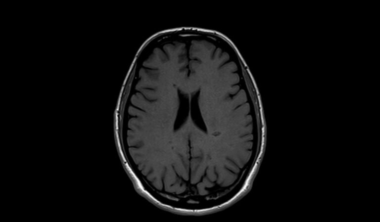 Multiple sclerosis(MS) MRI | Radiology Article on Multiple sclerosis