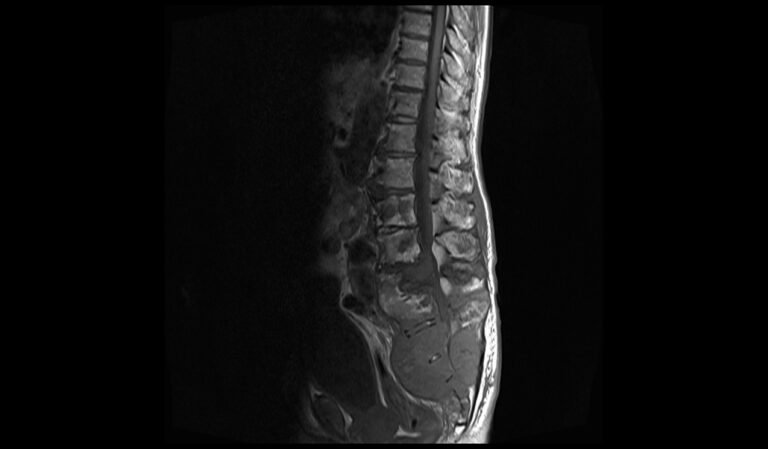Sacral metastases (Tumours) MRI | Radiology article on Sacral metastases