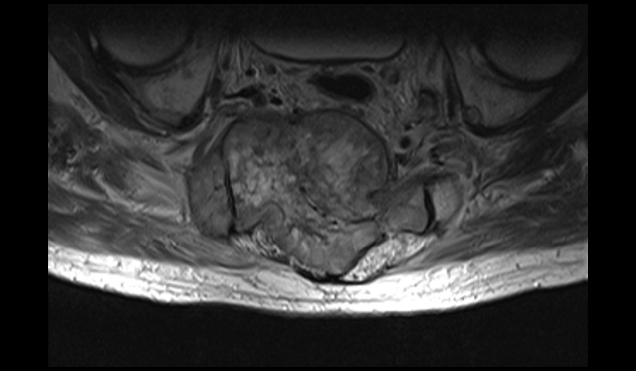 Sacral metastases (Tumours) MRI | Radiology article on Sacral metastases
