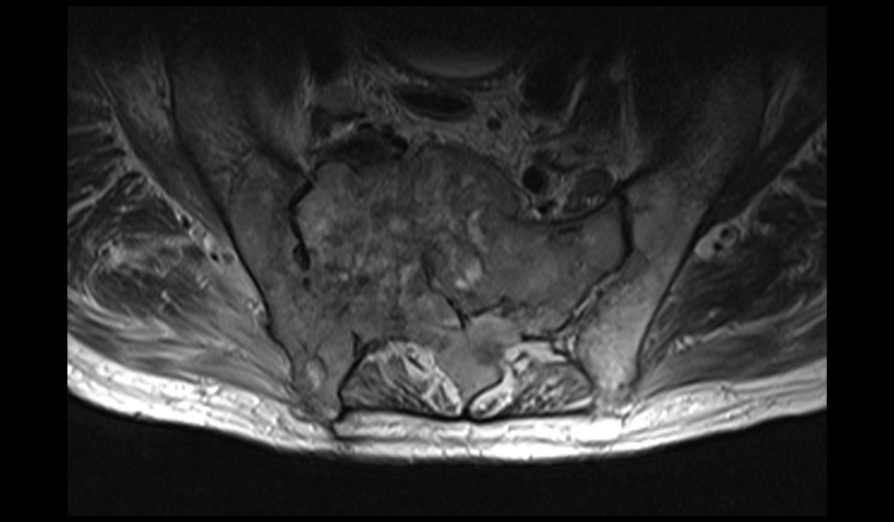 Sacral metastases (Tumours) MRI | Radiology article on Sacral metastases