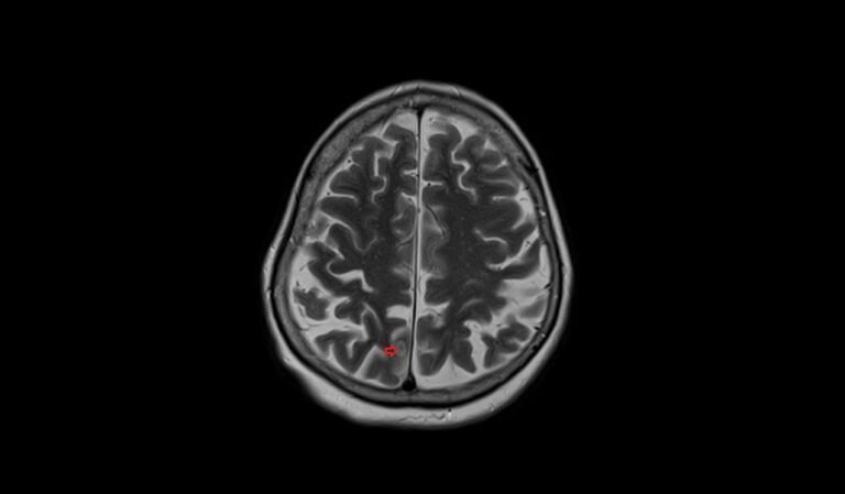 Tuberculoma MRI | Radiology Article on Brain Tuberculoma