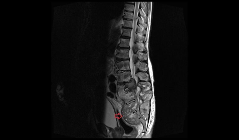 Sacral metastases (Tumours) MRI | Radiology article on Sacral metastases