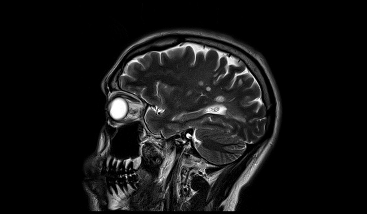 Multiple sclerosis(MS) MRI | Radiology Article on Multiple sclerosis